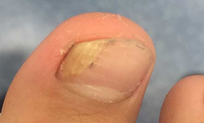 Onicomicose: Causas, Sintomas e Tratamentos Eficazes